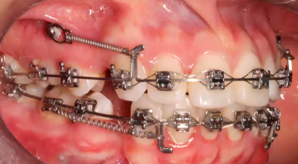 APLICACIÓN DEL MICROIMPLANTE EN LA PRÁCTICA DE ORTODONCIA - El Diario ...