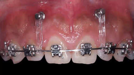 APLICACIÓN DEL MICROIMPLANTE EN LA PRÁCTICA DE ORTODONCIA - El Diario ...