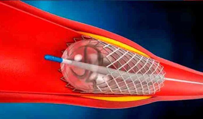 ANGIOPLASTIA, UNA FORMA NO INVASIVA DE ARREGLAR LAS ARTERIAS - El ...