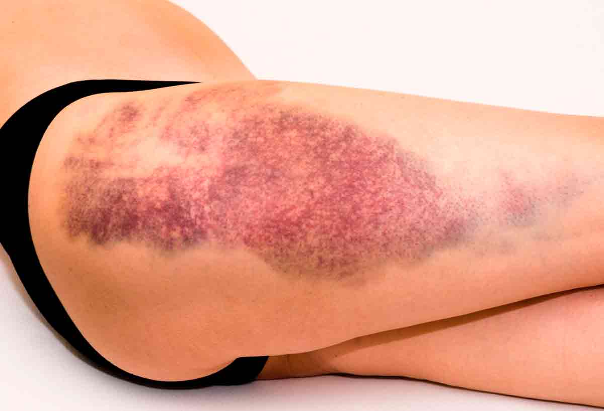 MORETONES QUE SE PRODUCEN CON FACILIDAD: ¿POR QUÉ OCURREN? - El Diario ...